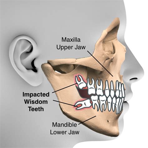 Image result for Impacted Wisdom Tooth Extraction