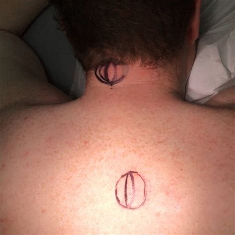 Image result for Upper-Back Cyst Surgery