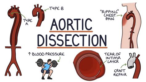 Image result for Type 2 Aortic Dissection