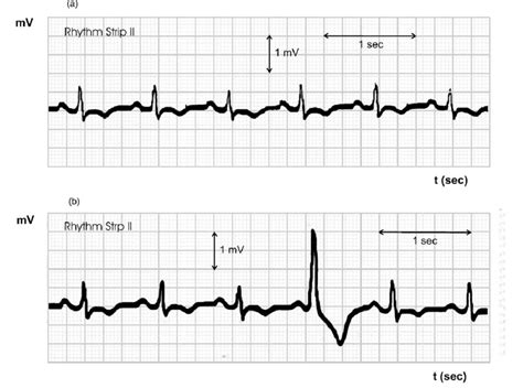 Image result for Normal ECG Range Chart