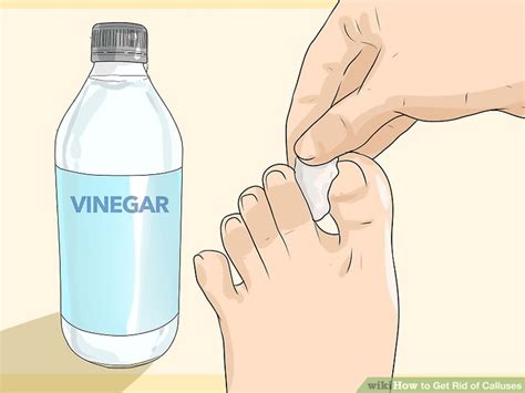 Image result for How to Remove Calluses Forever