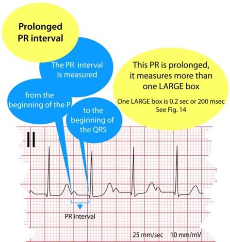 Image result for PR Interval ECG