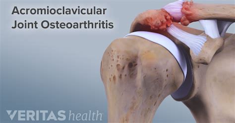 Image result for AC Joint Dysfunction