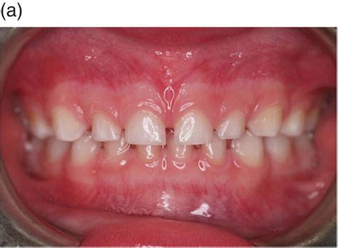 Image result for Tooth Development Video