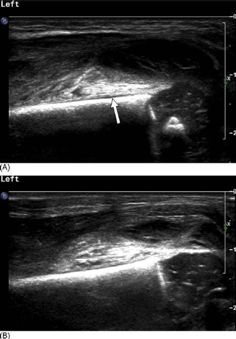 Image result for Triple Phase Bone Scan