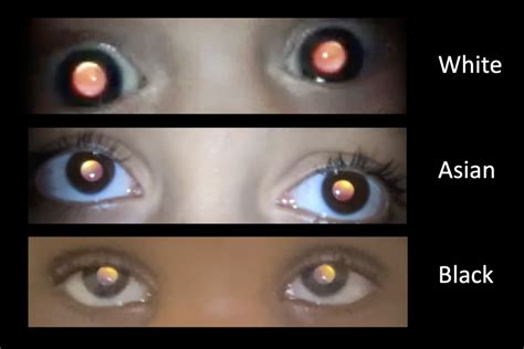 Image result for Red Reflex