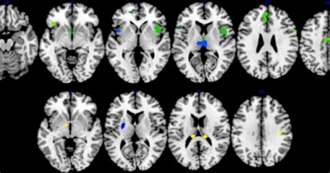 Image result for Manic Depression Problem