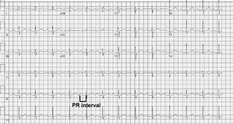 Image result for AV Block PR Interval