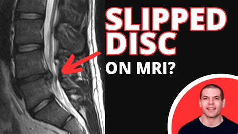 Image result for How to View MRI Disc
