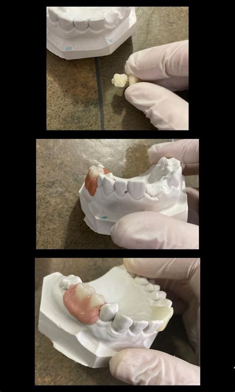 Image result for DIY Tooth Bridge Kit