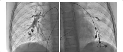 Image result for Angiogram with Embolization