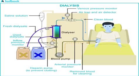 Image result for Dialysis Explained