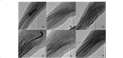 Image result for Radial Loop Angiogram