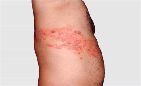 Image result for Shingles On Arm