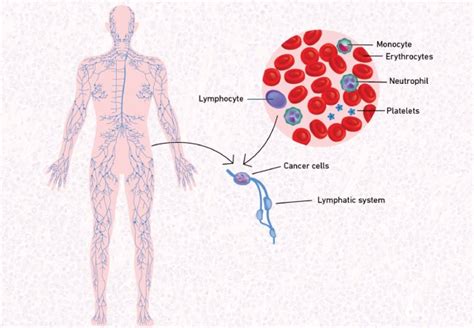 Image result for Diffuse Large Cell Lymphoma