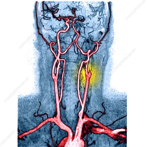 Image result for Heart Block Angiogram