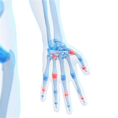 Image result for Joint cracking Risks