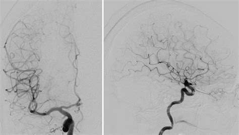 Image result for Embolization Procedure AVM