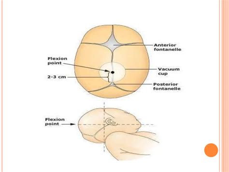 Image result for Obstetrical Version Procedure