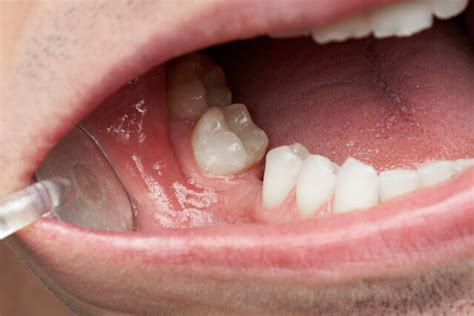 Image result for Avulsed Tooth