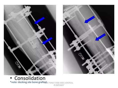 Image result for External Fixator Surgery