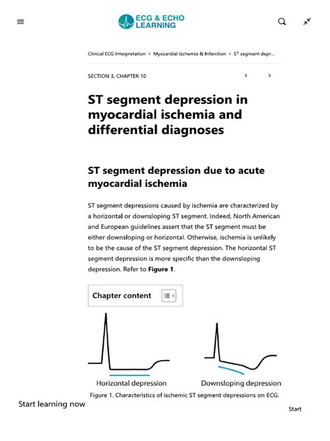 Image result for Types of ST Depression