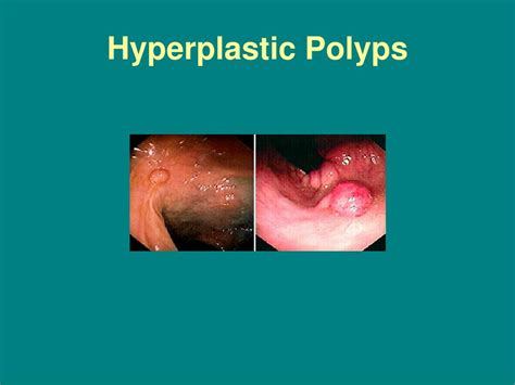 Image result for Colonoscopy Frequency Hyperpplastic Polyp