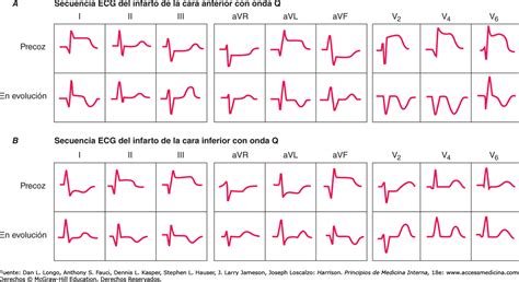 Image result for ECG 12 Derivaciones Normal