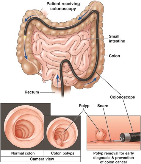 Image result for Normal Bowel Colonoscopy