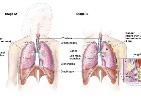Image result for How Fast Can Lung Cancer Develop