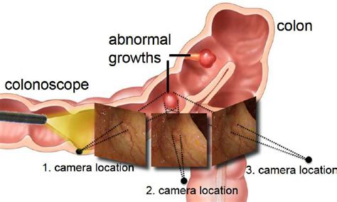 Image result for Colonoscopy Frequency Hyperpplastic Polyp