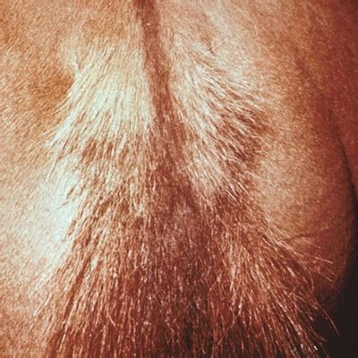 Image result for Pinworm Skin