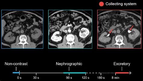 Image result for Urogram 3 Phase CT