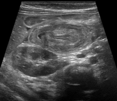 Image result for Intussusception Pseudokidney Sign