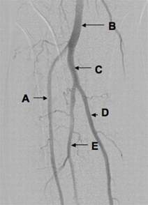 Image result for Left Lower Extremity Angiogram