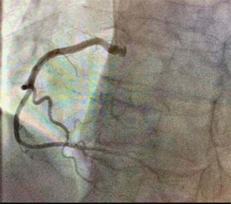 Image result for Normal Coronary Angiogram