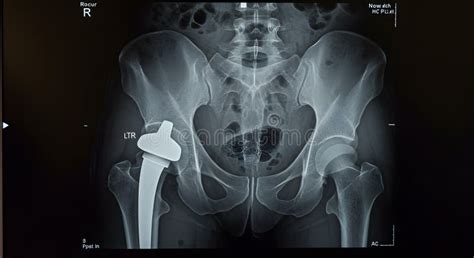 Image result for Hip-Replacement Post Operative Care