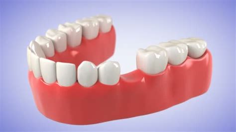 Image result for DIY Tooth Bridge Kit