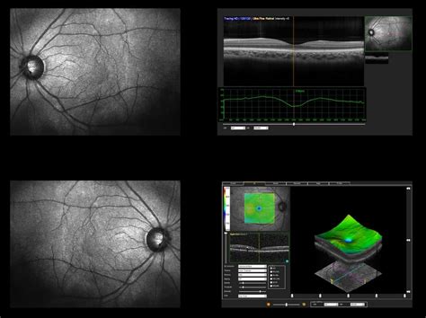 Image result for Oct Retinal Scan