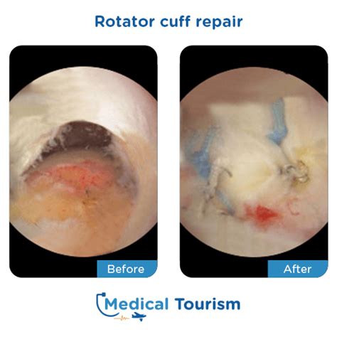Image result for Rotator Cuff Repair Surgery