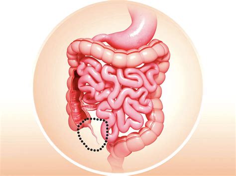 Image result for Appendix WHA Is It