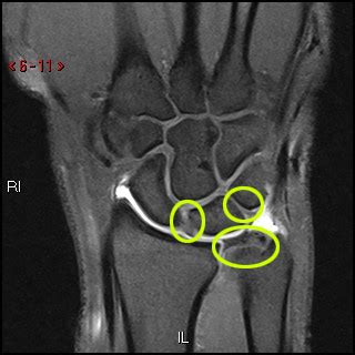 Image result for Wrist Arthrogram