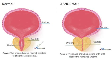 Image result for Prostate Operation Procedure