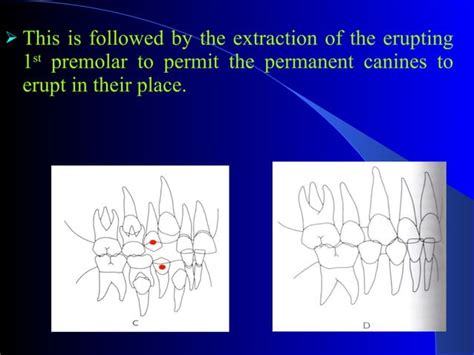 Image result for Serial Extraction Case Report
