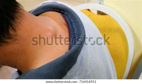 Image result for Upper-Back Cyst Surgery