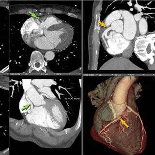 Image result for Normal Coronary CT Angiogram