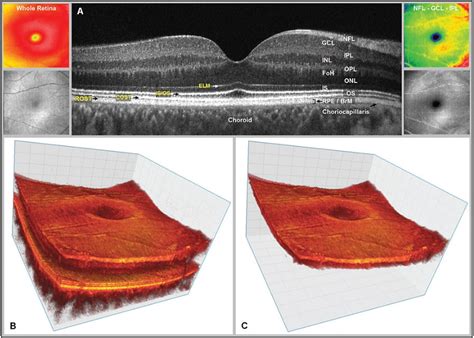 Image result for Oct Retinal Scan Interpretation