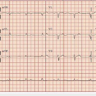 Image result for Heart Block Angiogram