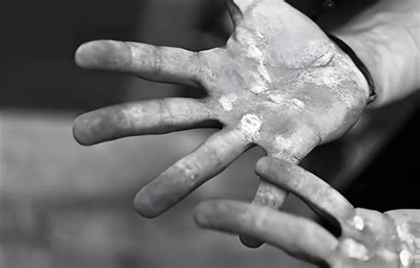 Image result for How to Remove Calluses From Hand