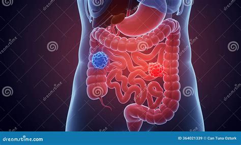 Image result for Colonoscopy Colon Cancer Polyps